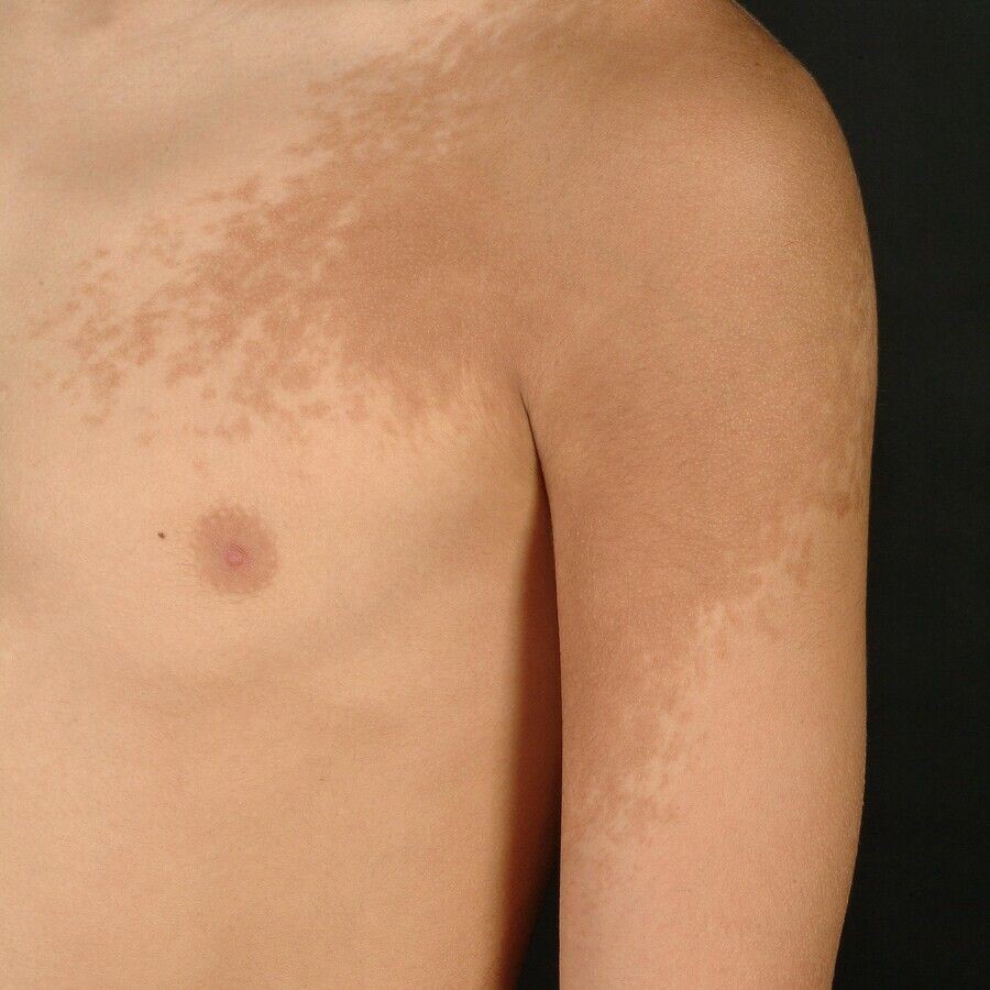 Bớt Becker (Becker’s Nevus)