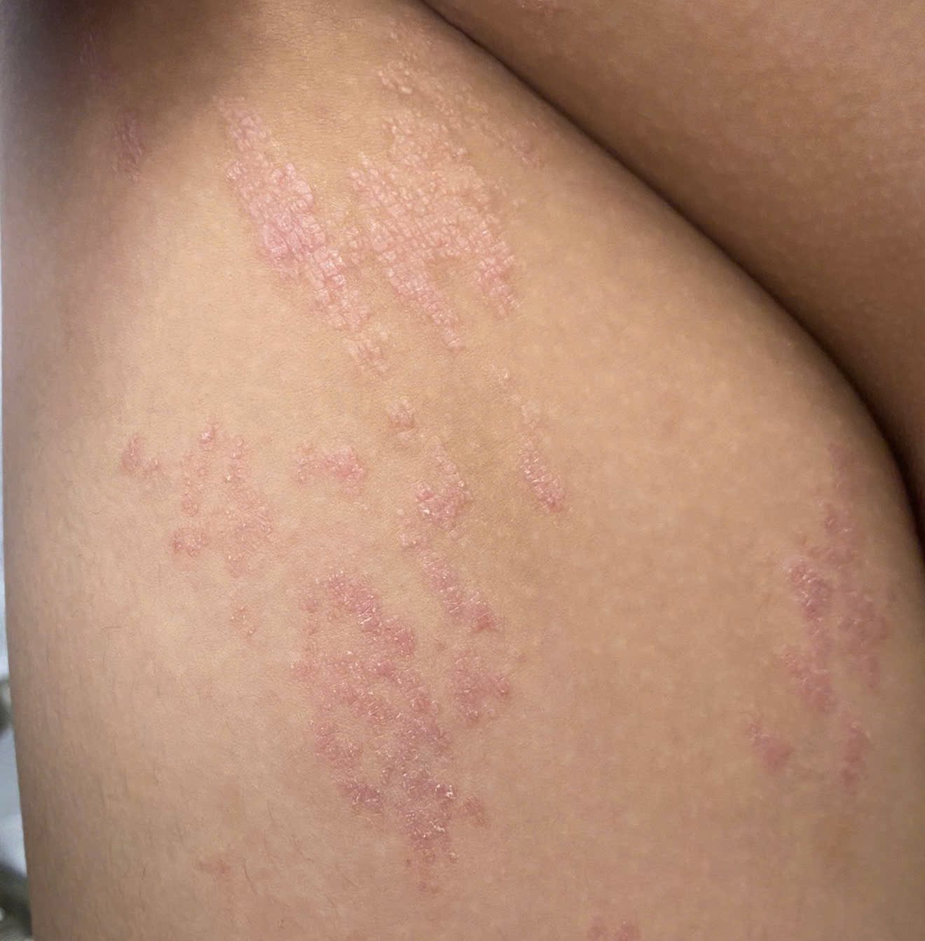 Lichen thành dải (Lichen Striatus)