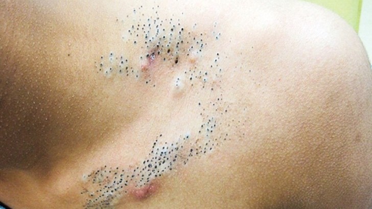 Nevus comedonicus